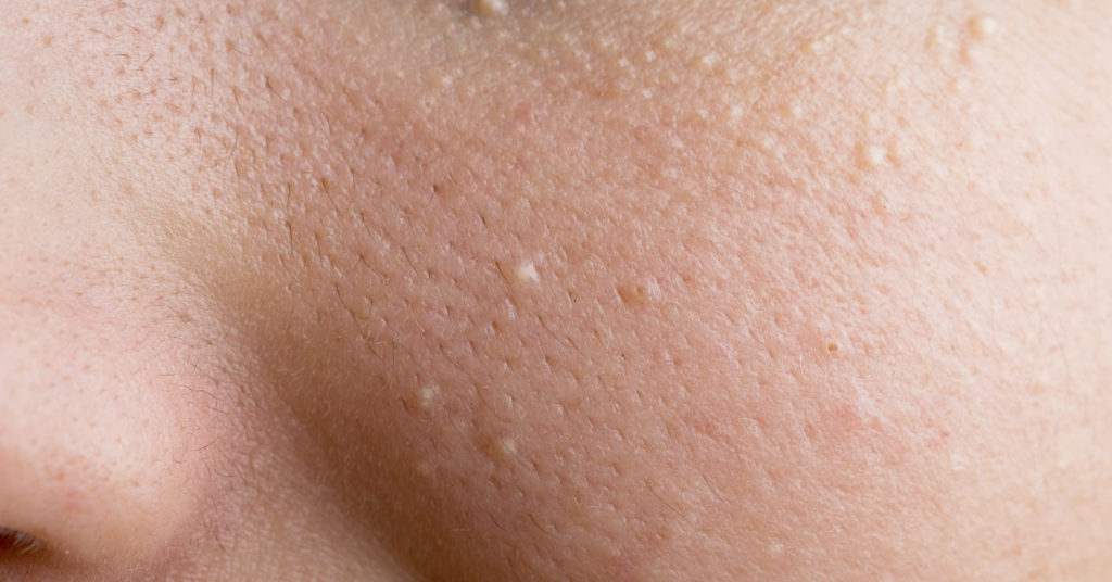 What Are Those Little White Bumps on Your Skin? They're Milia and Here ...