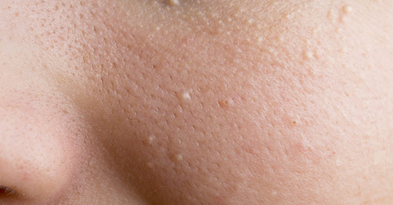 What Are Those Little White Bumps on Your Skin? They're Milia and Here ...
