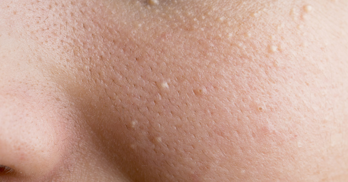 What Are Those Little White Bumps On Your Skin They re Milia And Here What Are Those Little White Bumps On Your Skin They re Milia And Here