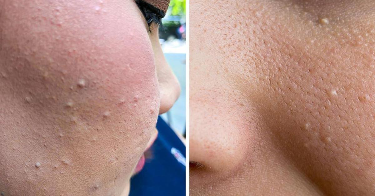 What Are Those Little White Bumps on Your Skin? They're Milia and Here ...