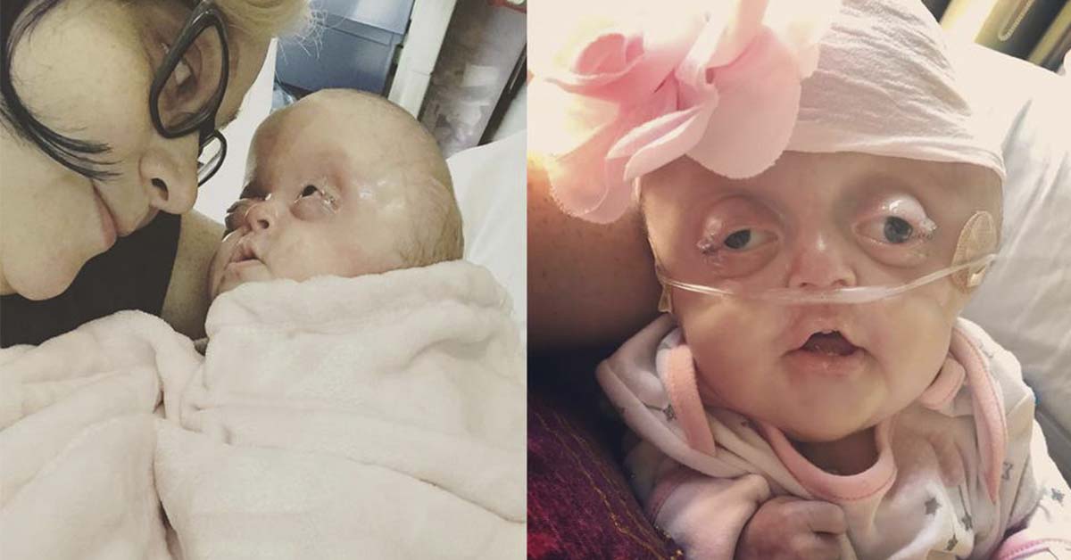 Mother describes first moments meeting her child with Pfeiffer Syndrome