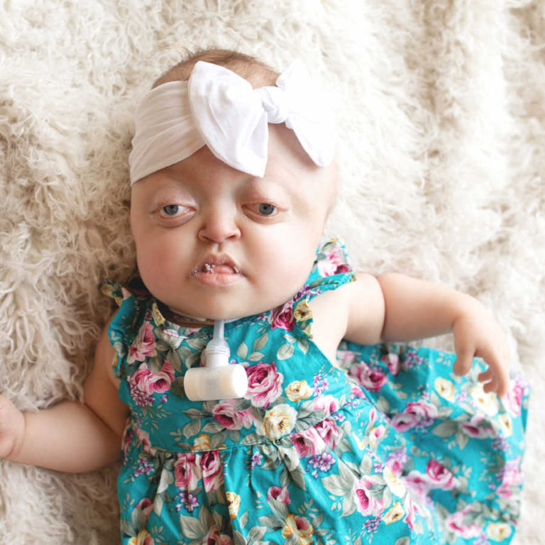 Mother describes first moments meeting her child with Pfeiffer Syndrome