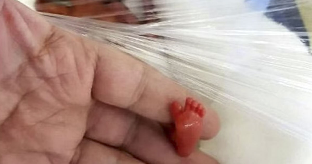 Premature baby born weighing less than a pound was one of the smallest ...