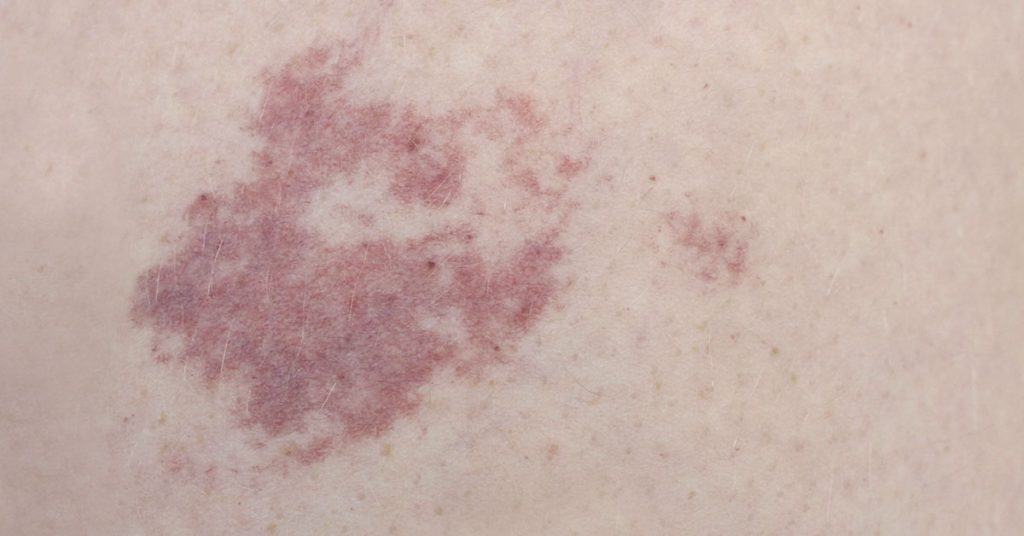 Baby With Red Birthmark Called 'Hideous' And 'Defective', But Wait Till ...