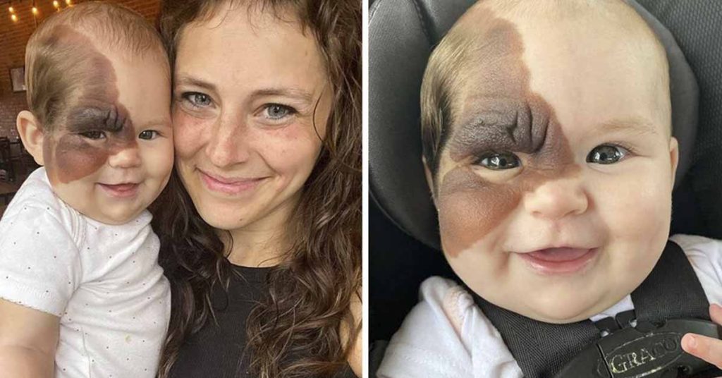 Little Winry Was Born With a Rare Birthmark, and Her Mom Shows How ...