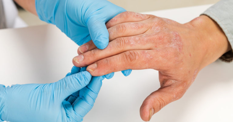 Dyshidrotic Eczema Signs, Symptoms, And Treatment