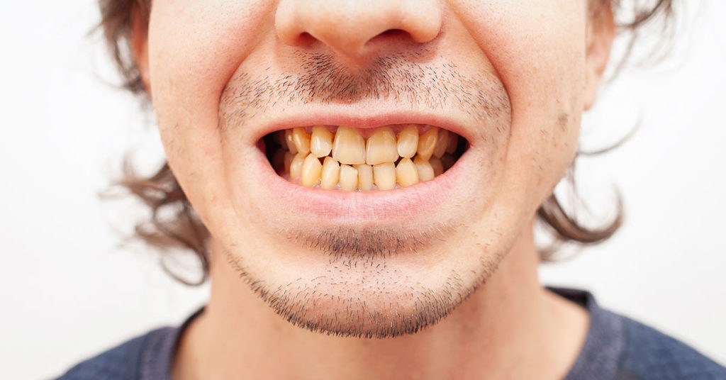 Dentist Explains 7 Key Causes of Yellowing Teeth and How to Prevent It ...