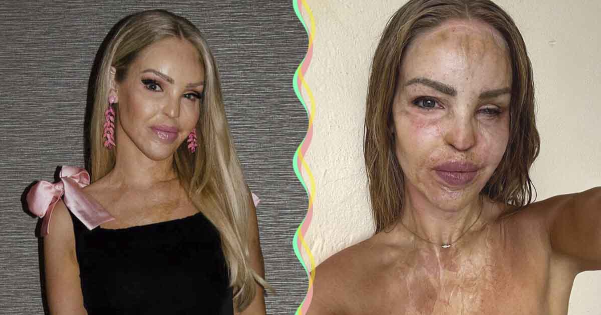 16 Years After Acid Attack, Katie Piper Shares Bright New Chapter ...