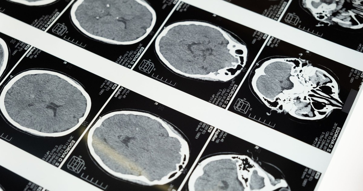 Doctors Thought He Had Brain Cancer. It Was Tapeworm Infection Instead.